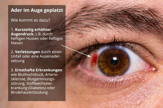 Was tun, wenn eine Ader im Auge geplatzt ist? - Sieu Thi Do Noi That Was tun, wenn eine Ader im Auge geplatzt ist? - Sieu Thi Do Noi That